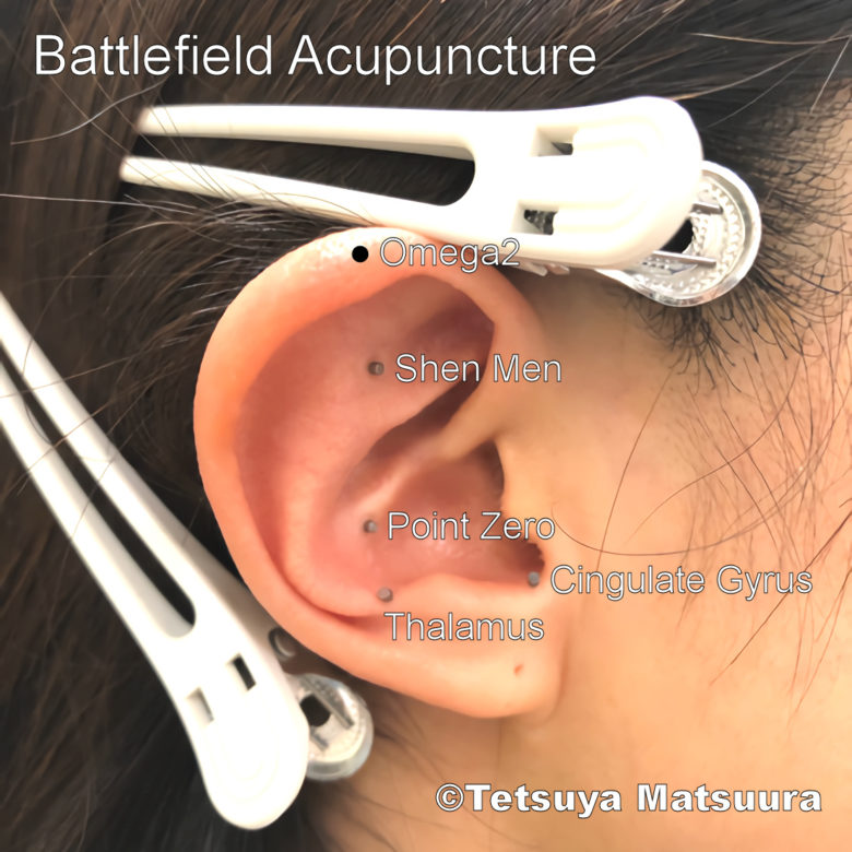 Battlefield Acupuncture（BFA・戦場鍼）とは | BFA JAPAN｜戦場鍼ハンズオンセミナー